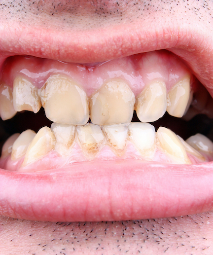 three ways prevent tooth decay gum disease